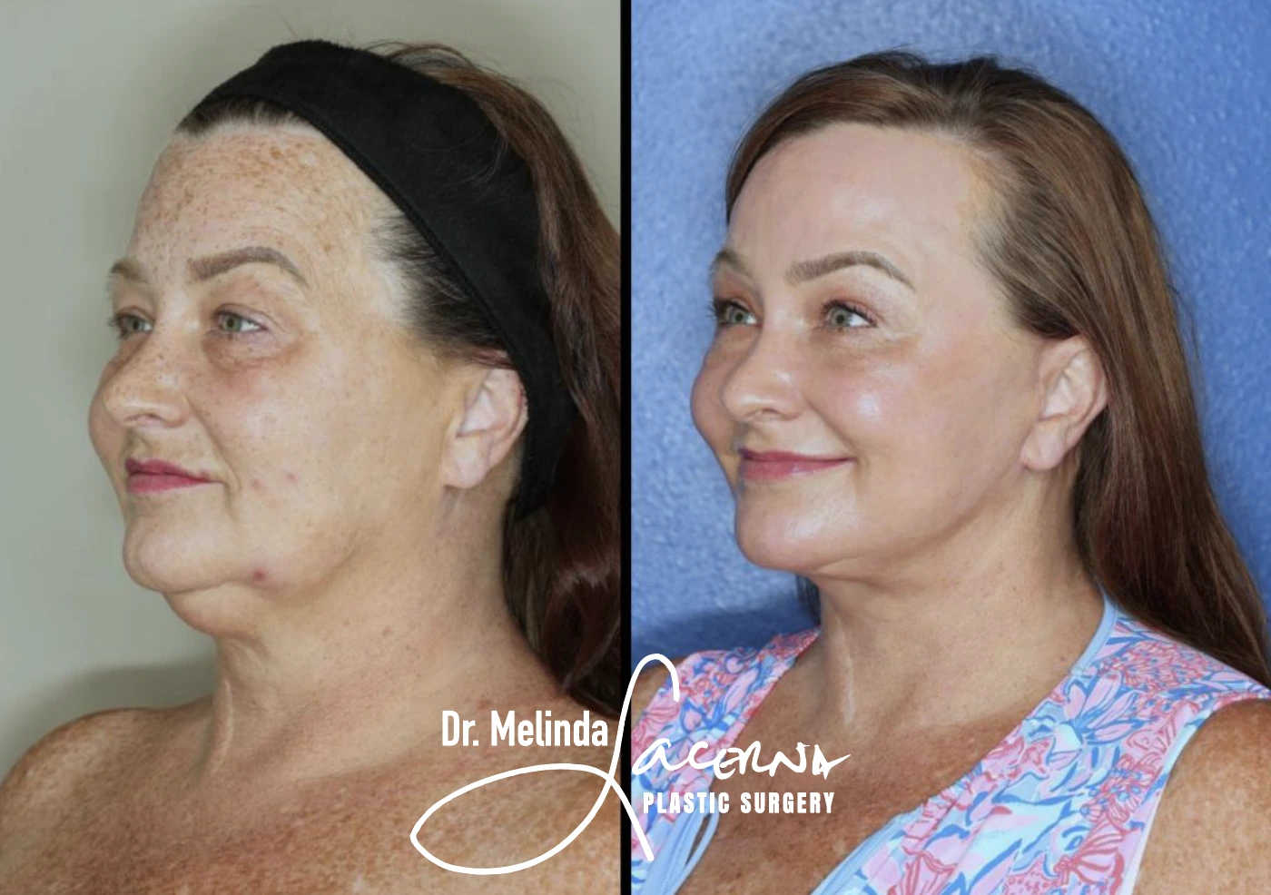 Expert Neck Lift Service in Bradenton, FL | Neck Rejuvenation