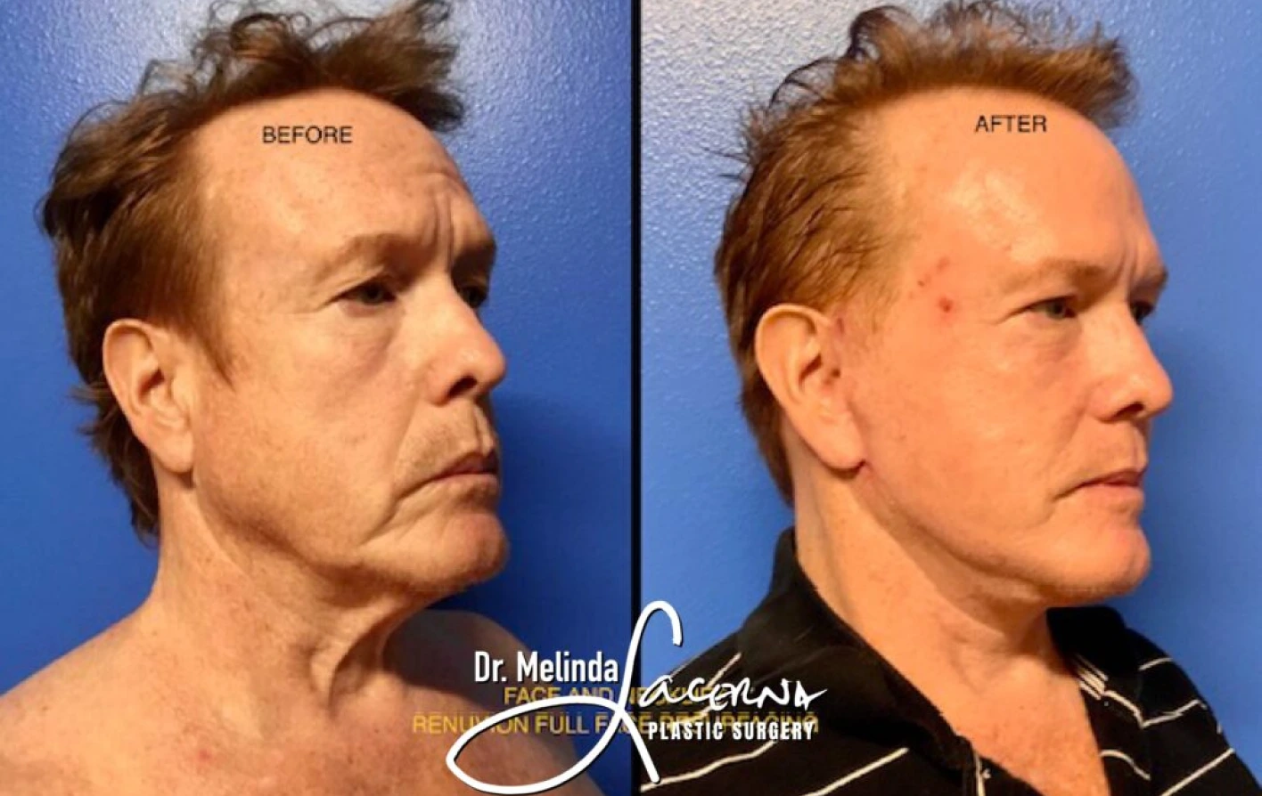 Best Facelift in Bradenton, FL | Anti Aging Facelift Surgery